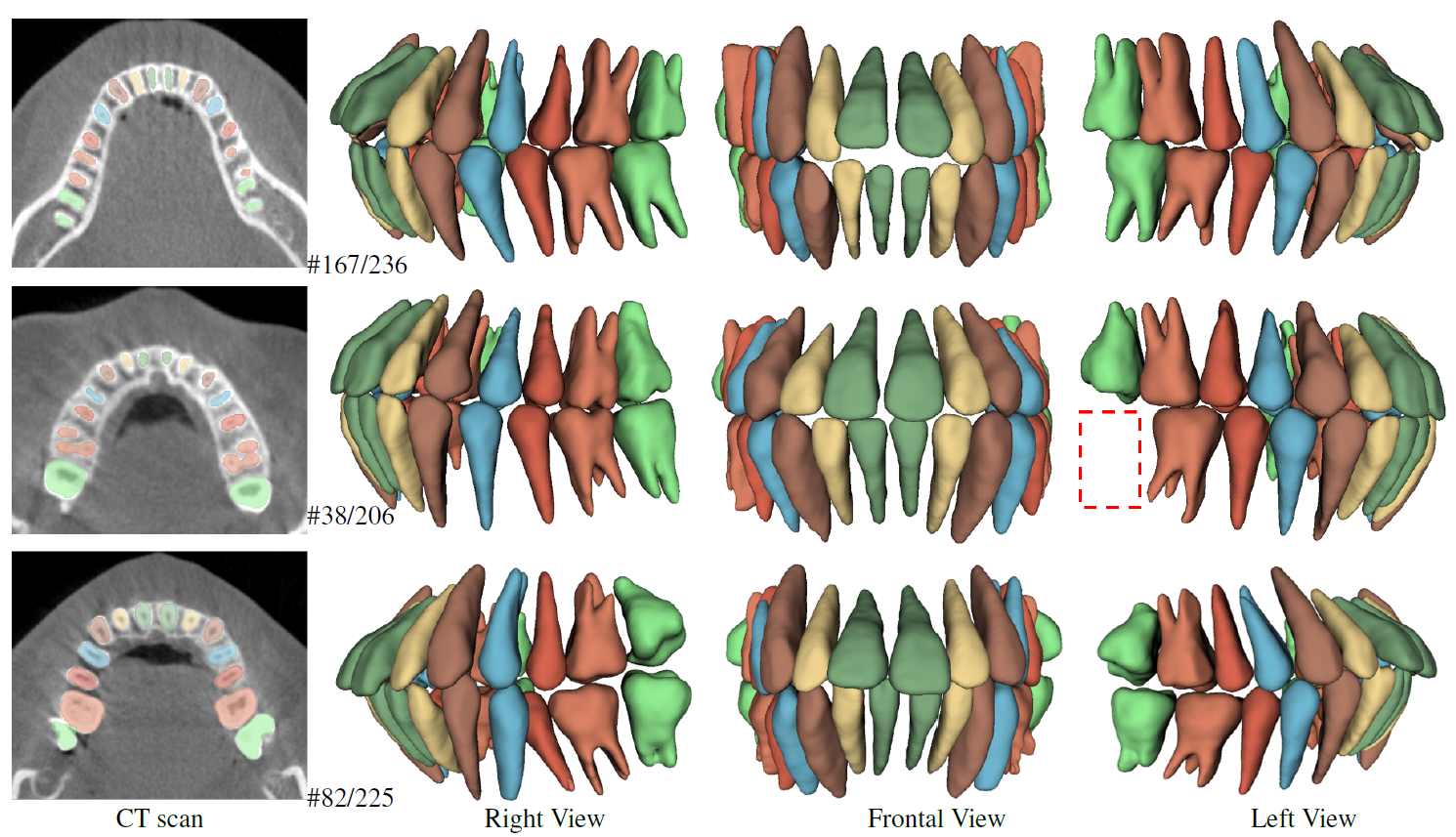 Automatic Tooth Segmentation From 3d Dental Model Usi - vrogue.co Automatic Tooth Segmentation From 3d Dental Model Usi - vrogue.co