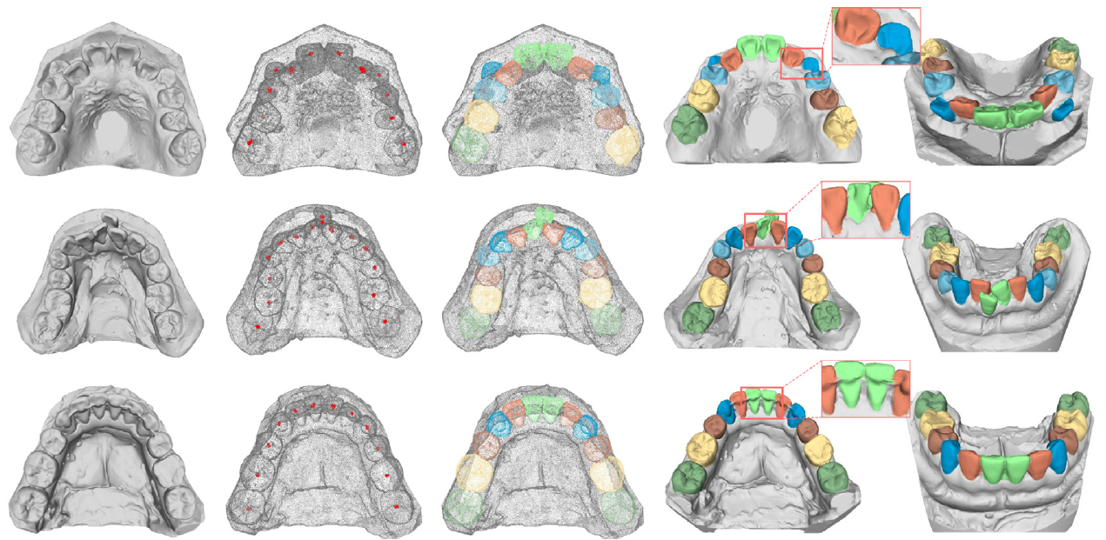 Tsegnet An Efficient And Accurate Tooth Segmentation Network On 3d Dental Model